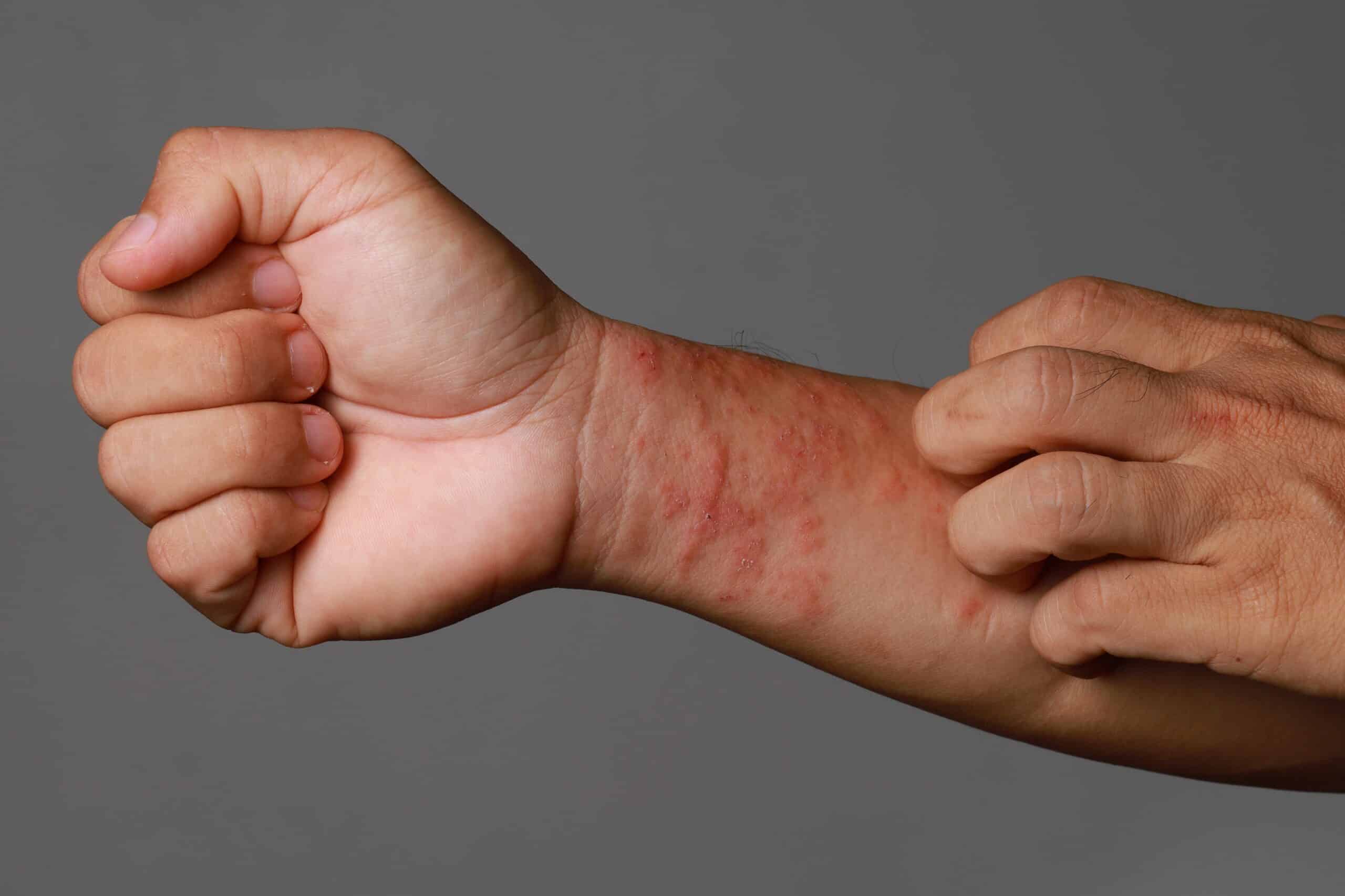 Atopic Dermatitis: Myth Busters and Dispelling Misinformation - MDBriefCase